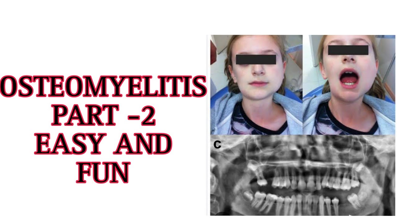 OSTEOMYELITIS PART -2 || SHORT AND EASY || WITH PICTURES - YouTube