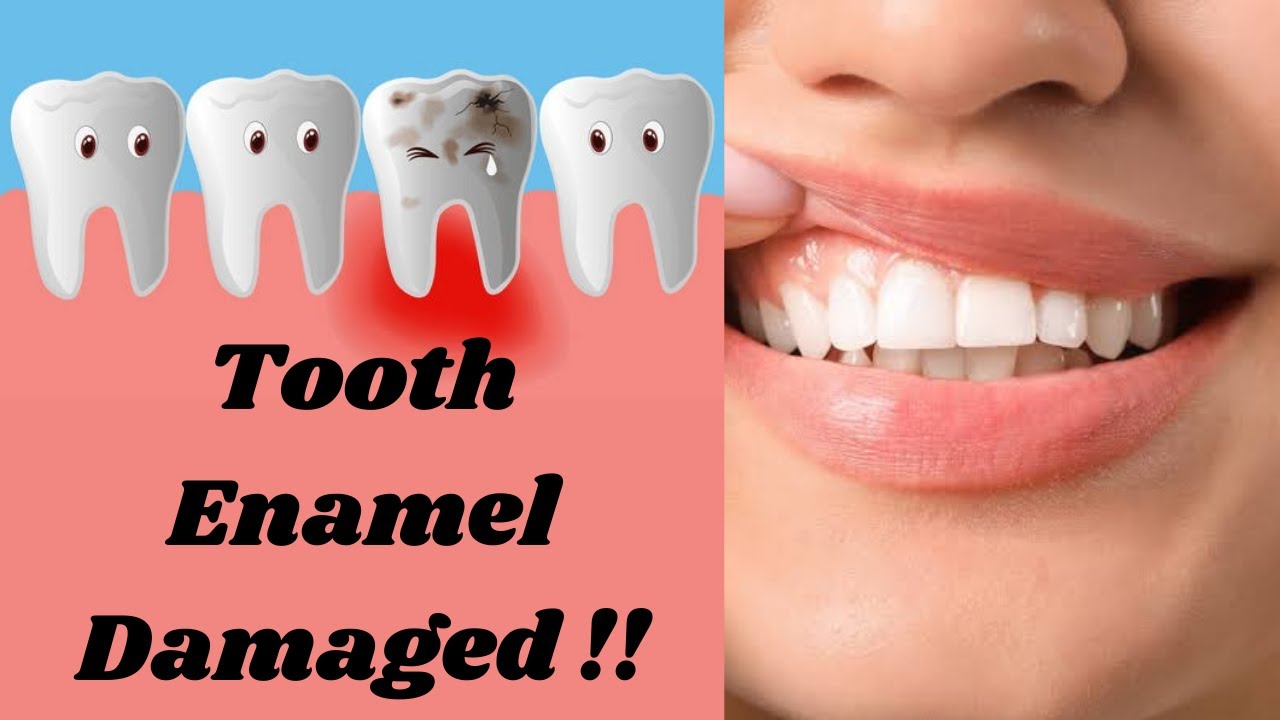 Tooth enamel loss| Tooth enamel| Tooth enamel can’t be restored| broken ...