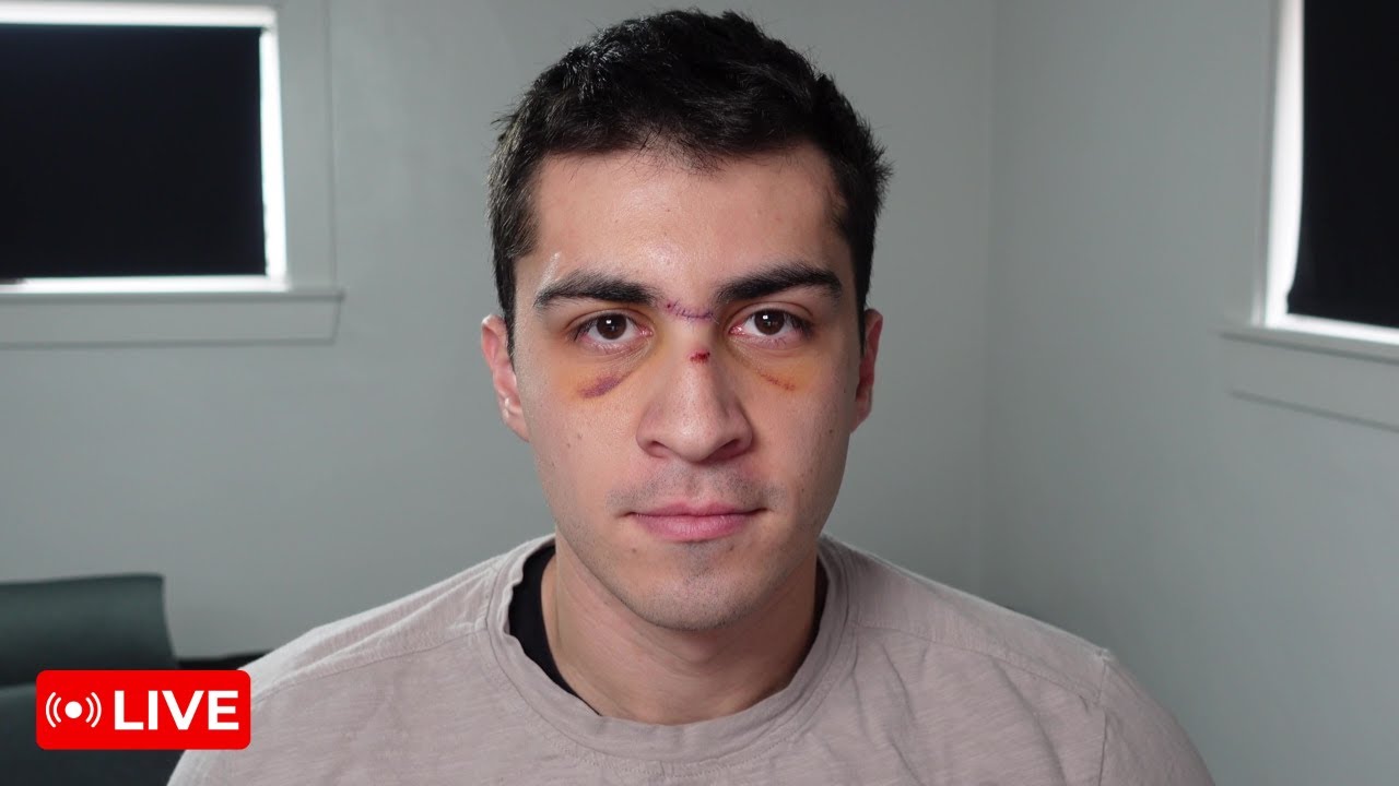 My Face Injury, Updates, & WordPress Q&A (LIVE) - YouTube