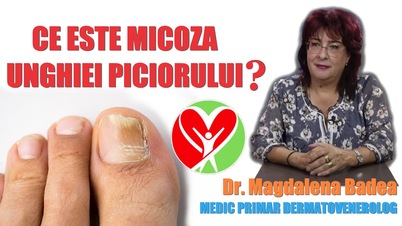 Ce este micoza unghiei piciorului? | Dr. Magdalena Badea - Medic Primar ...
