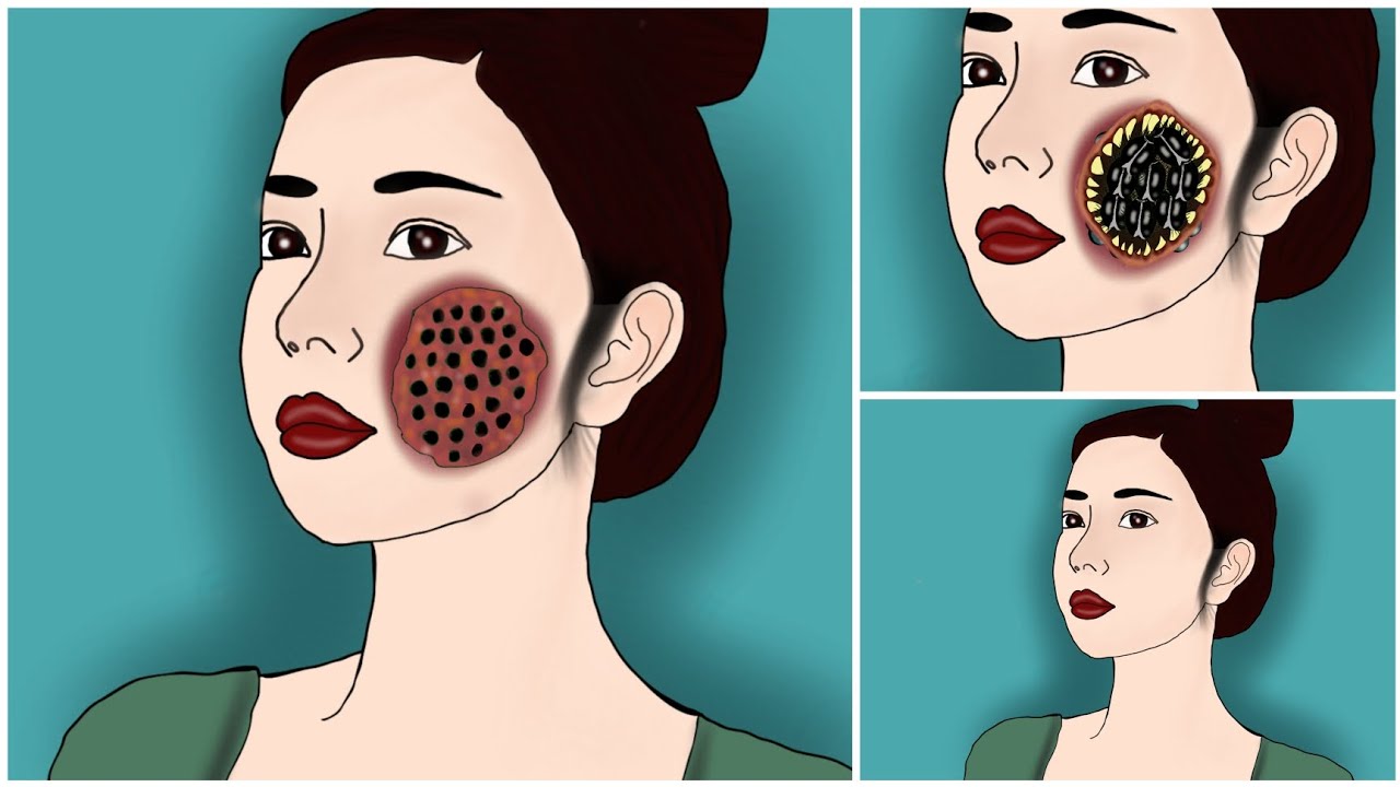 Deep Cleaning Trypophobia from the face | Asmr treatment animation ...