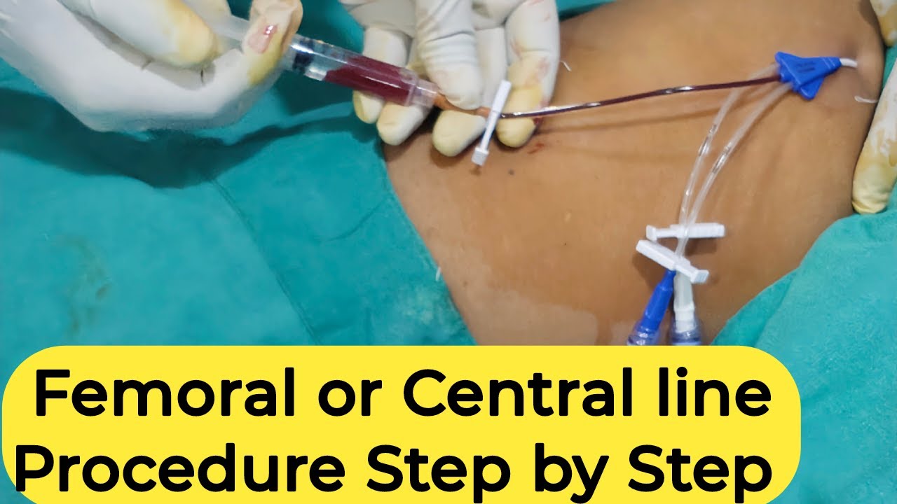 Femoral Or Central Line Procedure Step By Step Dr Subodh YouTube