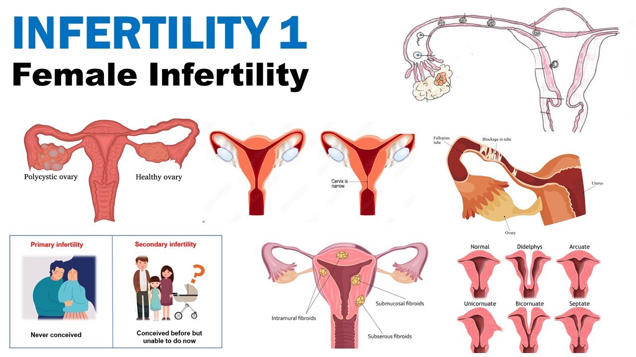 Infertility - 1 | Introduction | Causes of Female Infertility | Dr ...