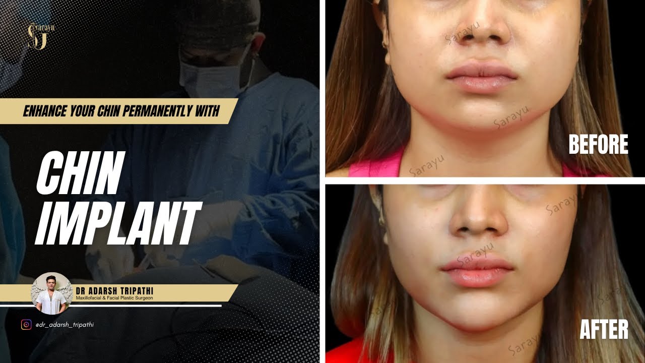 Chin Implant Transformation by Dr. Adarsh Tripathi | Sarayu Clinics # ...