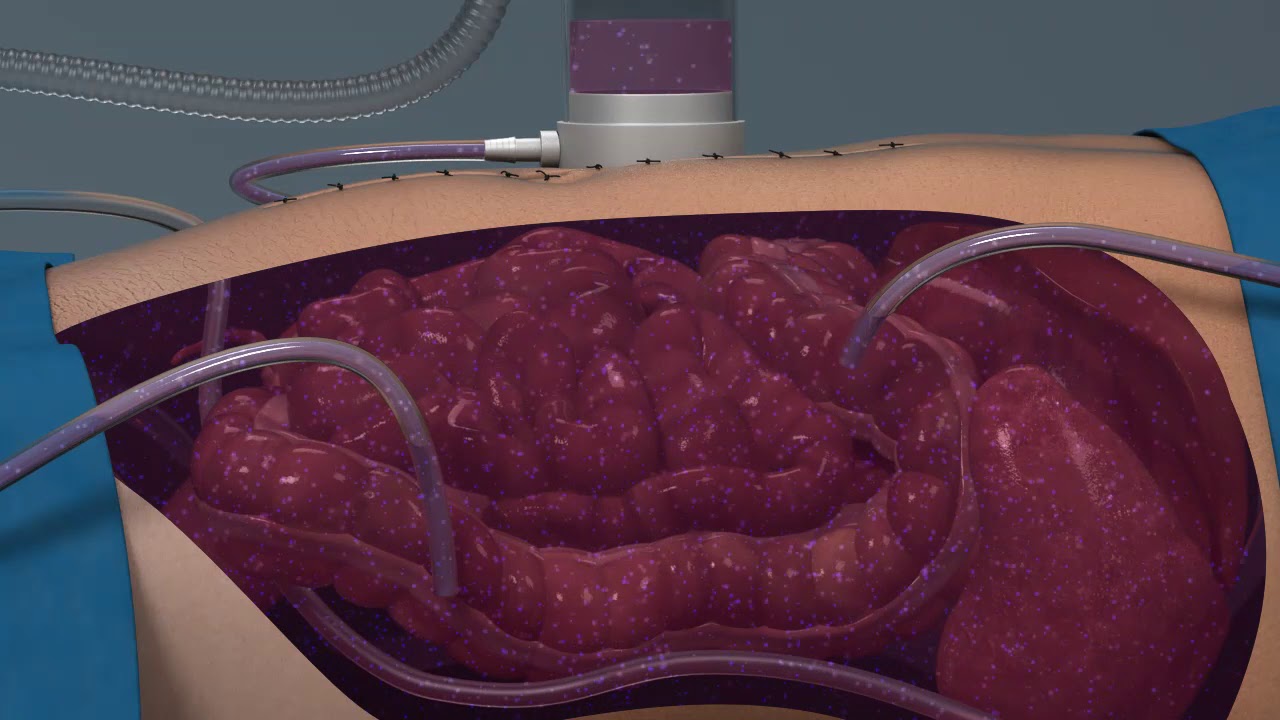 HIPEC CO2 Closed Animation - YouTube