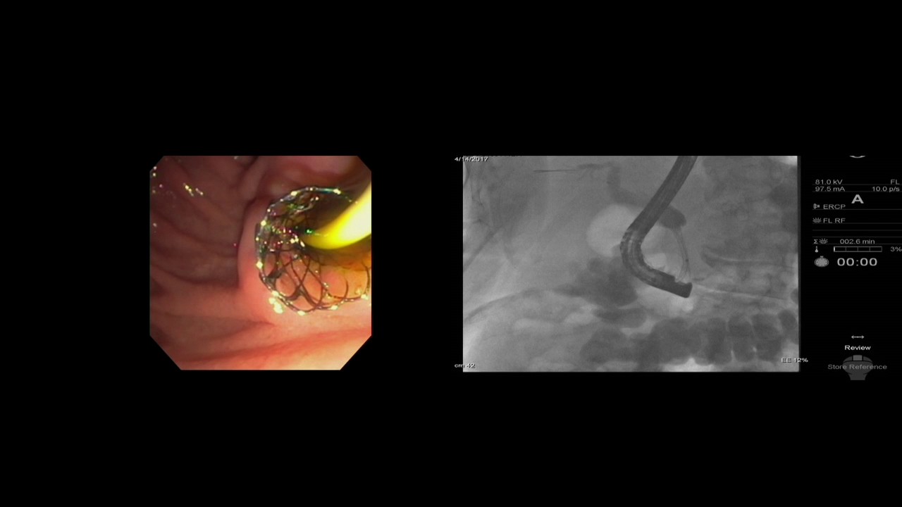 Malignant Biliary Obstruction ERCP - YouTube