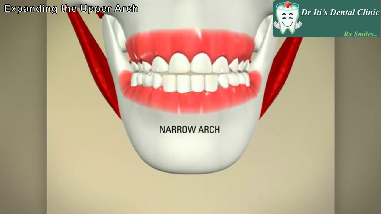Expansion Of Dental Arch/Jaws - YouTube