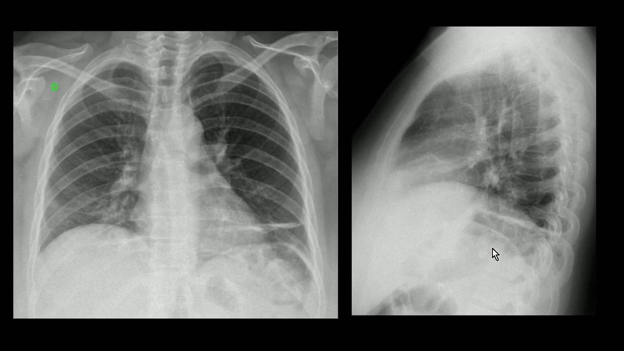 Rx do Tórax - YouTube