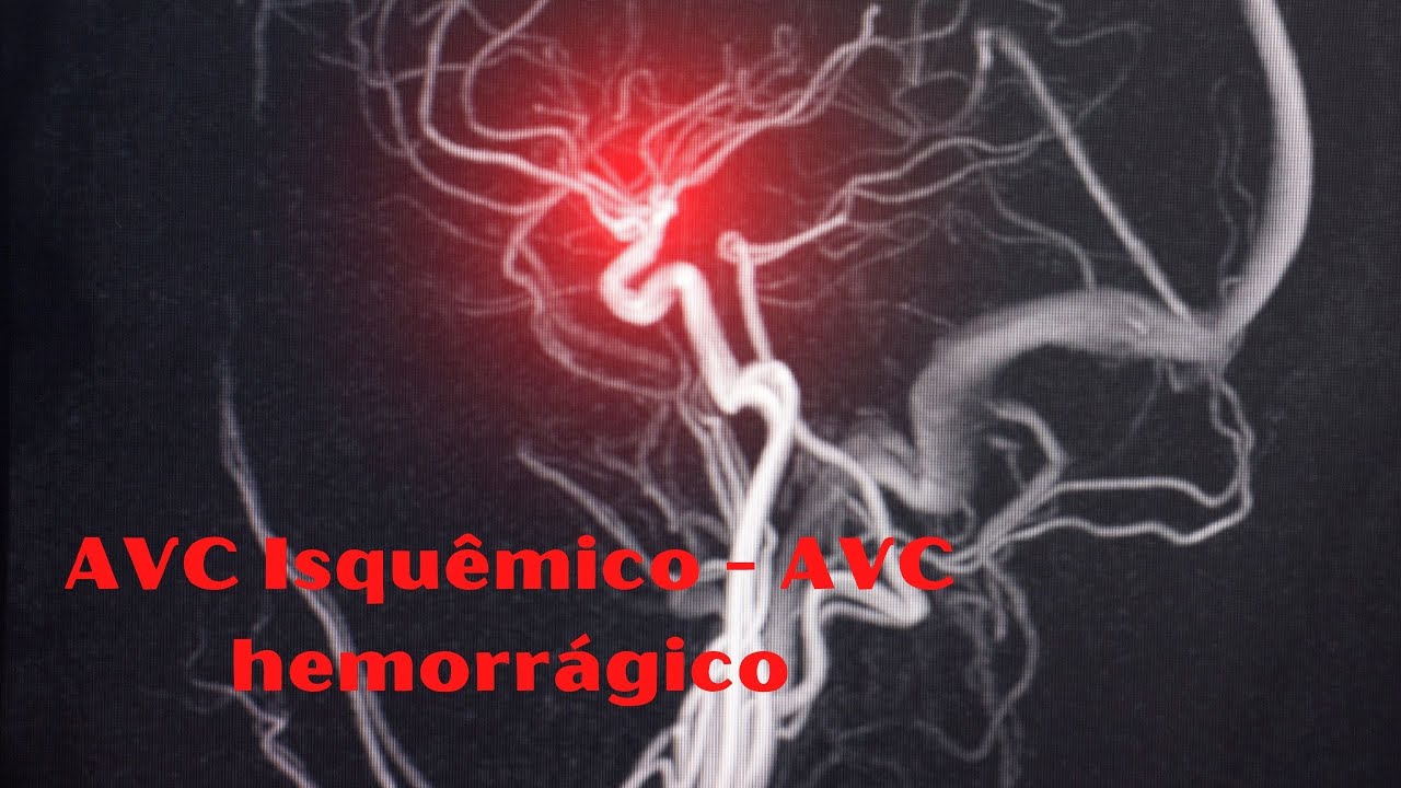 AVC Isquêmico AVC hemorrágico - YouTube