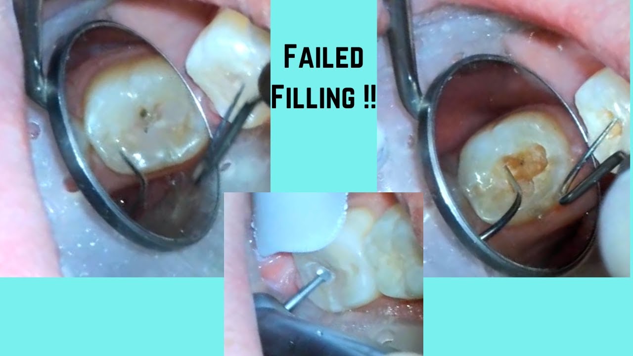 Replacing a white filling - YouTube