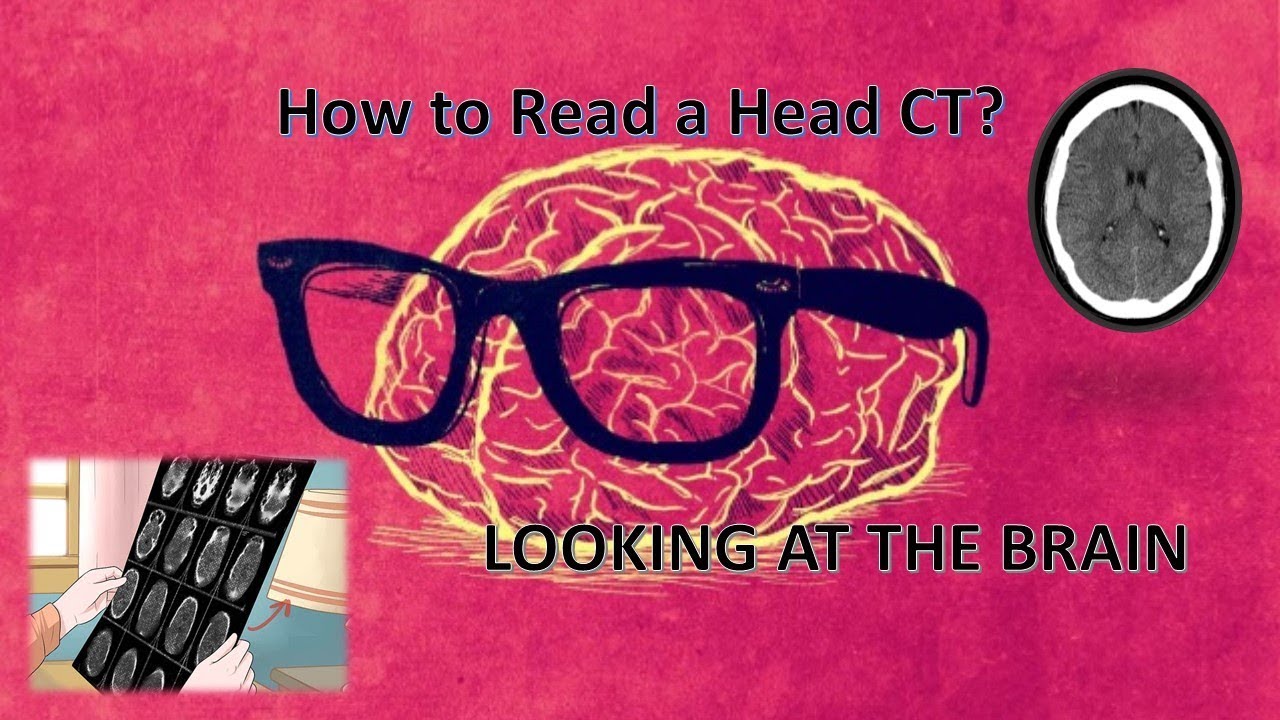 How to Read a Head CT in an Emergency Room? - YouTube