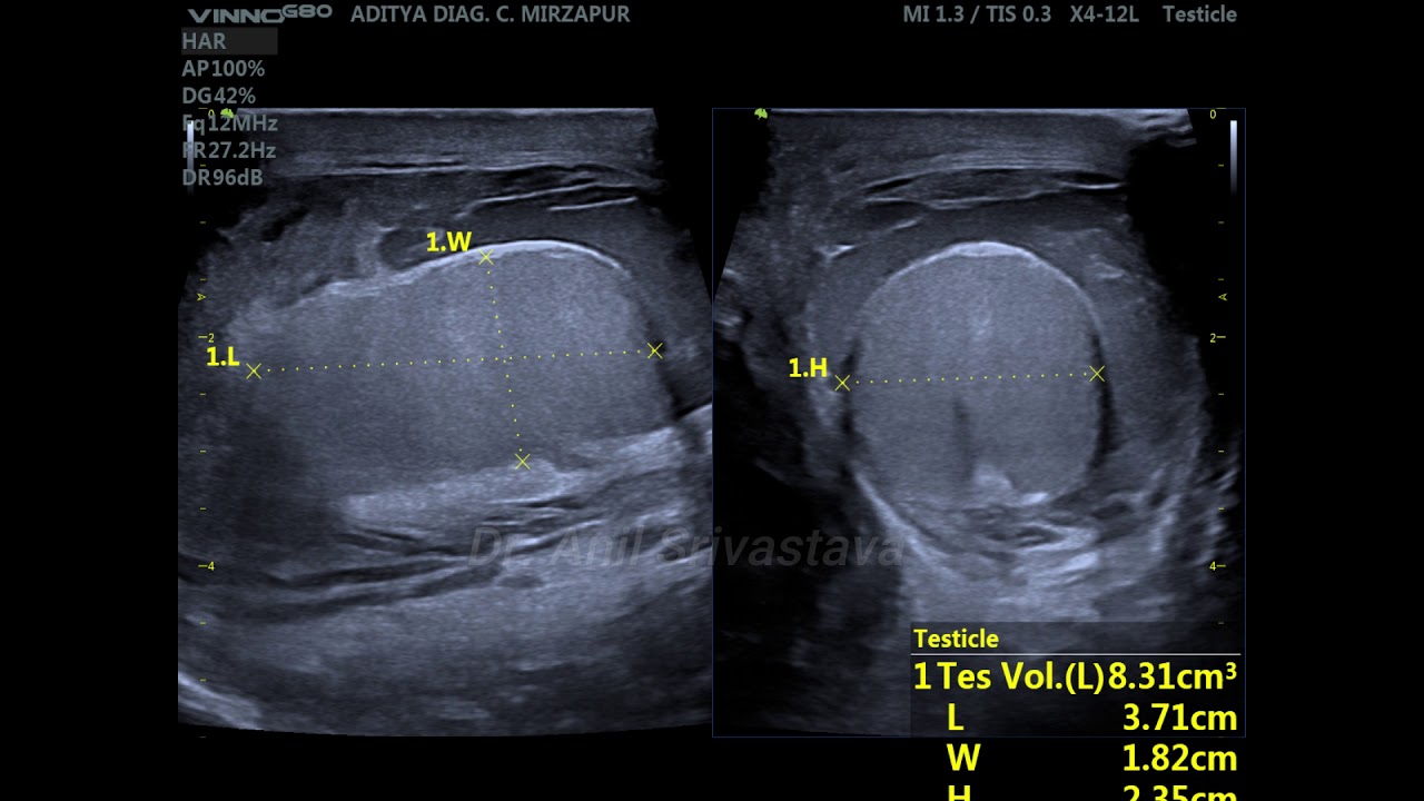 CRUSH INJURY TESTICLE - YouTube