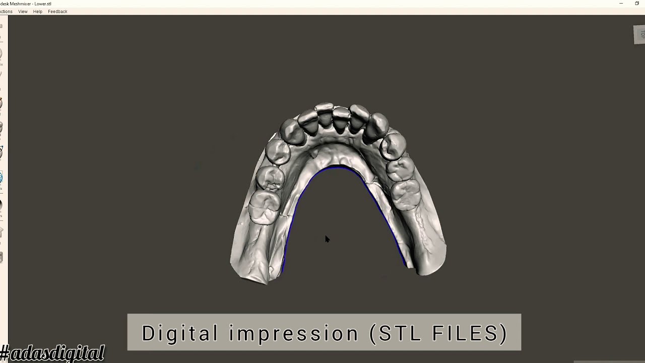 DTX Studio Implant DTX Studio Lab NobelBiocare #digitaldentistry # ...