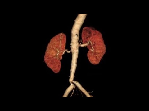 Takayasu arteritis Type- IV CT angiography - YouTube