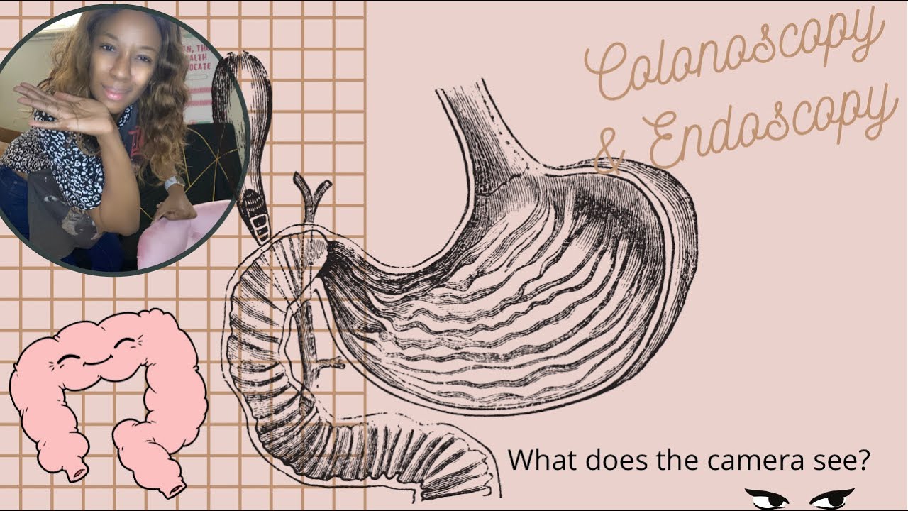 The Camera Goes Where ?!? My Colonoscopy & Endoscopy Experience # ...