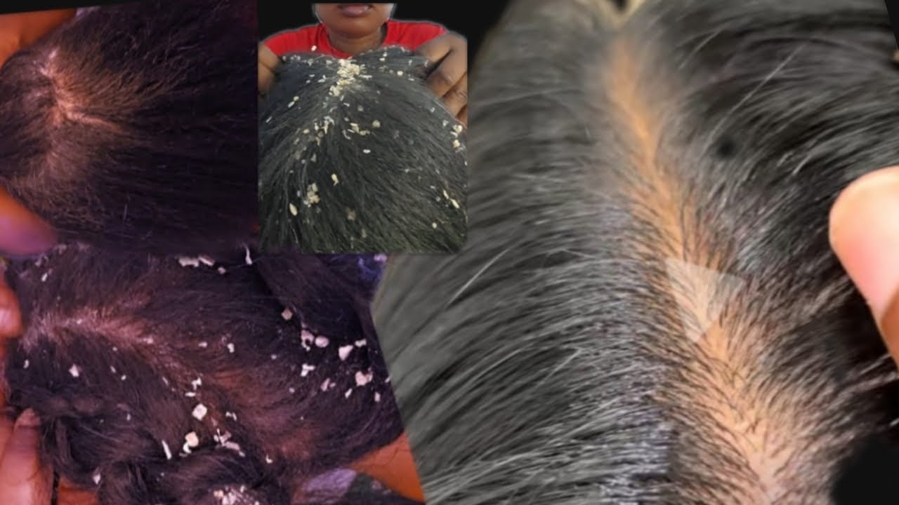 ASMR 🌟 dandruff removal fast & Aggressive scalp scratch satisfying for ...