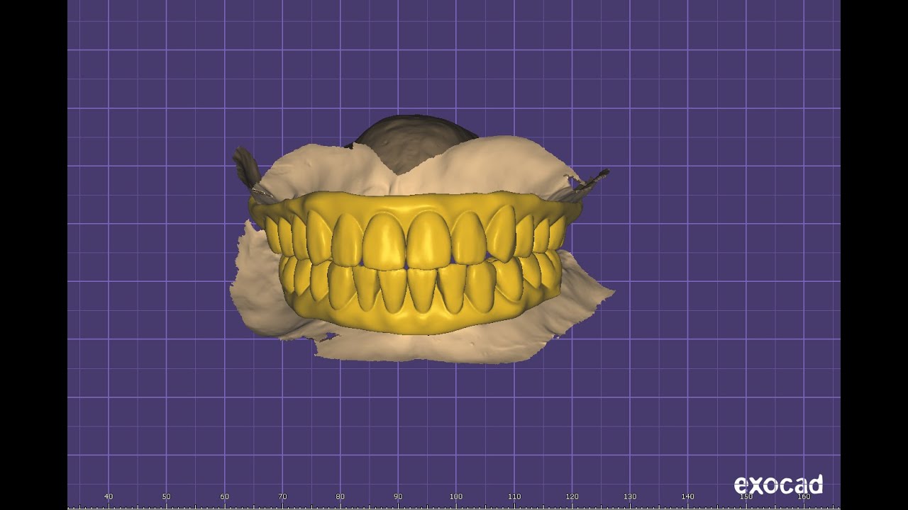 Upper full arch and lower anterior designing in exocad... - YouTube
