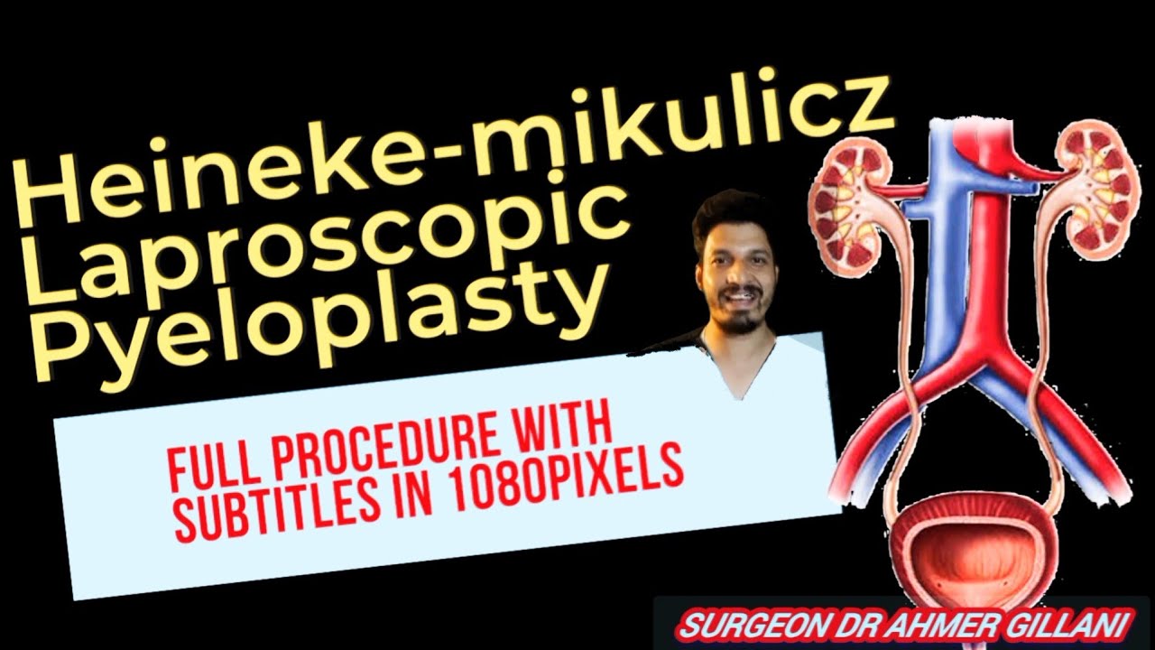 Heineke-mikulicz Laproscopic Pyeloplasty Stepwise Uncut Full Operative ...