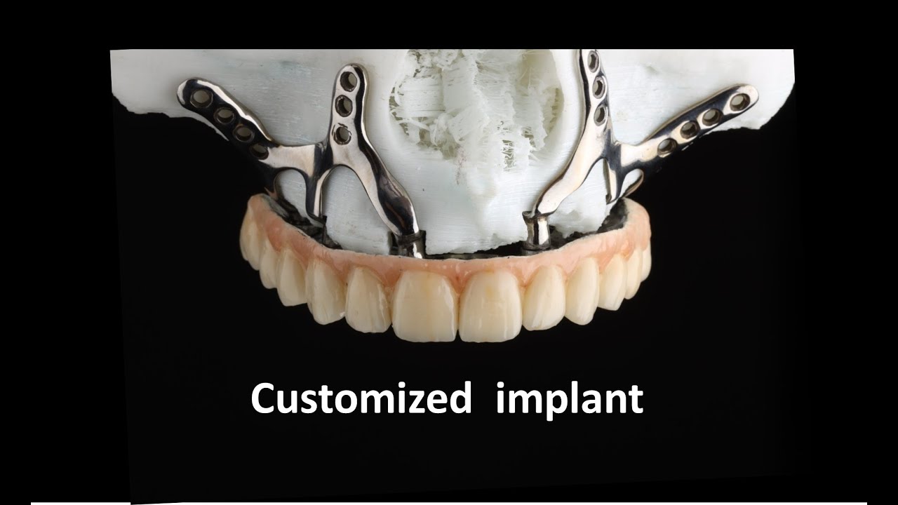 Customized implant with screw retain Prosthesis for atrophic bone ...