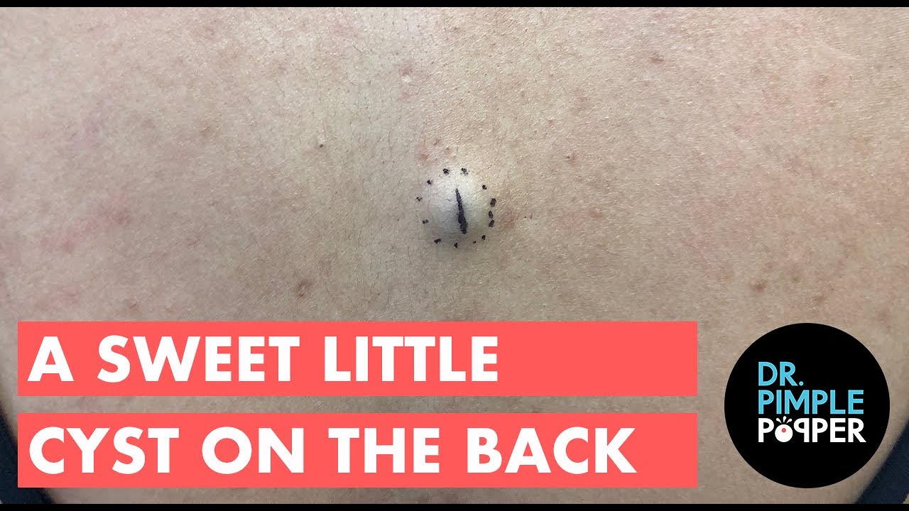 A Sweet Little Cyst on the Back - YouTube