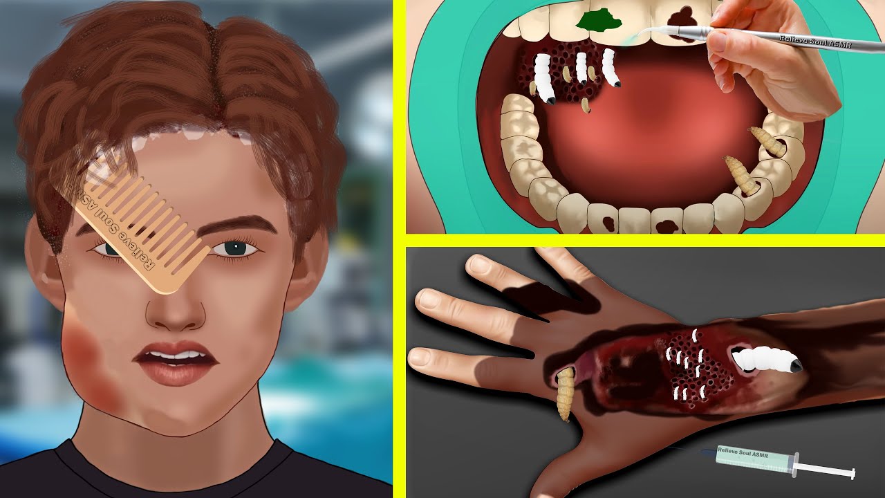 💟 ASMR ☮️ SATISFYING Surgery Treatment With Big Flakes, Mouth Maggots ...
