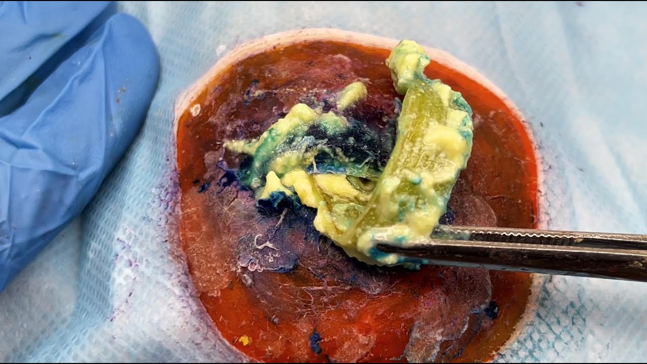 SAC DEP SPA Cystic Acne, 𝐀 𝐆𝐢𝐚𝐧𝐭 𝐁𝐥𝐚𝐜𝐤𝐡𝐞𝐚𝐝𝐬 𝐑𝐞𝐦𝐨𝐯𝐚𝐥 𝐄𝐱𝐭𝐫𝐚𝐜𝐭𝐢𝐨𝐧 𝐒𝐡𝐨𝐮𝐥𝐝𝐧 ...