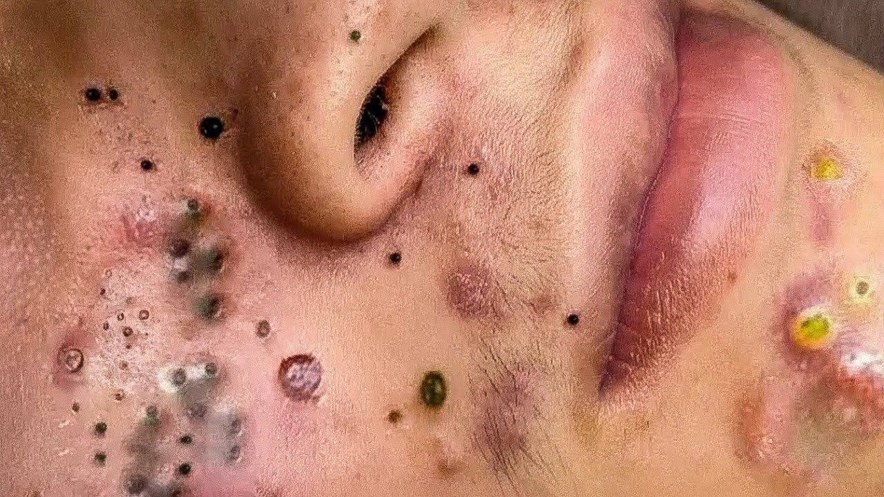 Satisfying Blackhead Removal & Deep Skin Cleansing | ASMR Facial ...