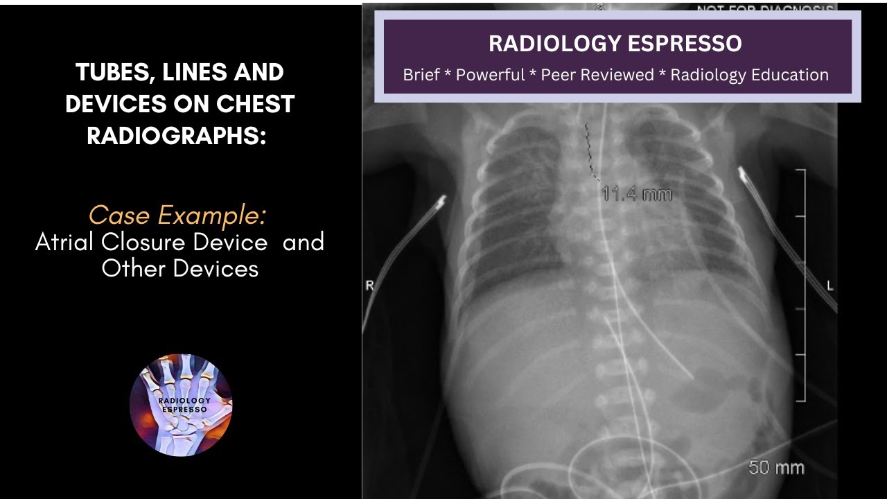 TUBES, LINES AND DEVICES ON CHEST RADIOGRAPHS: Case Example - Pacemaker ...