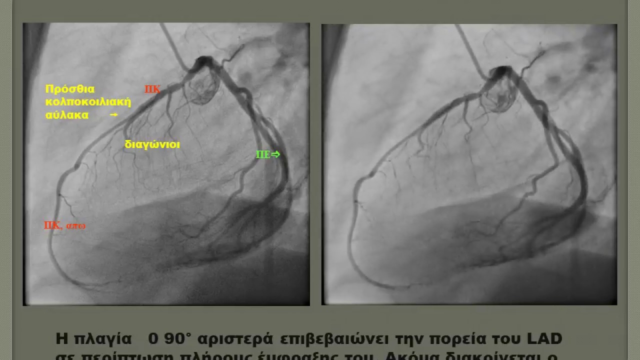 Χρήσιμες Προβολές Στεφανιογραφίας. Εκπαίδευση. - YouTube