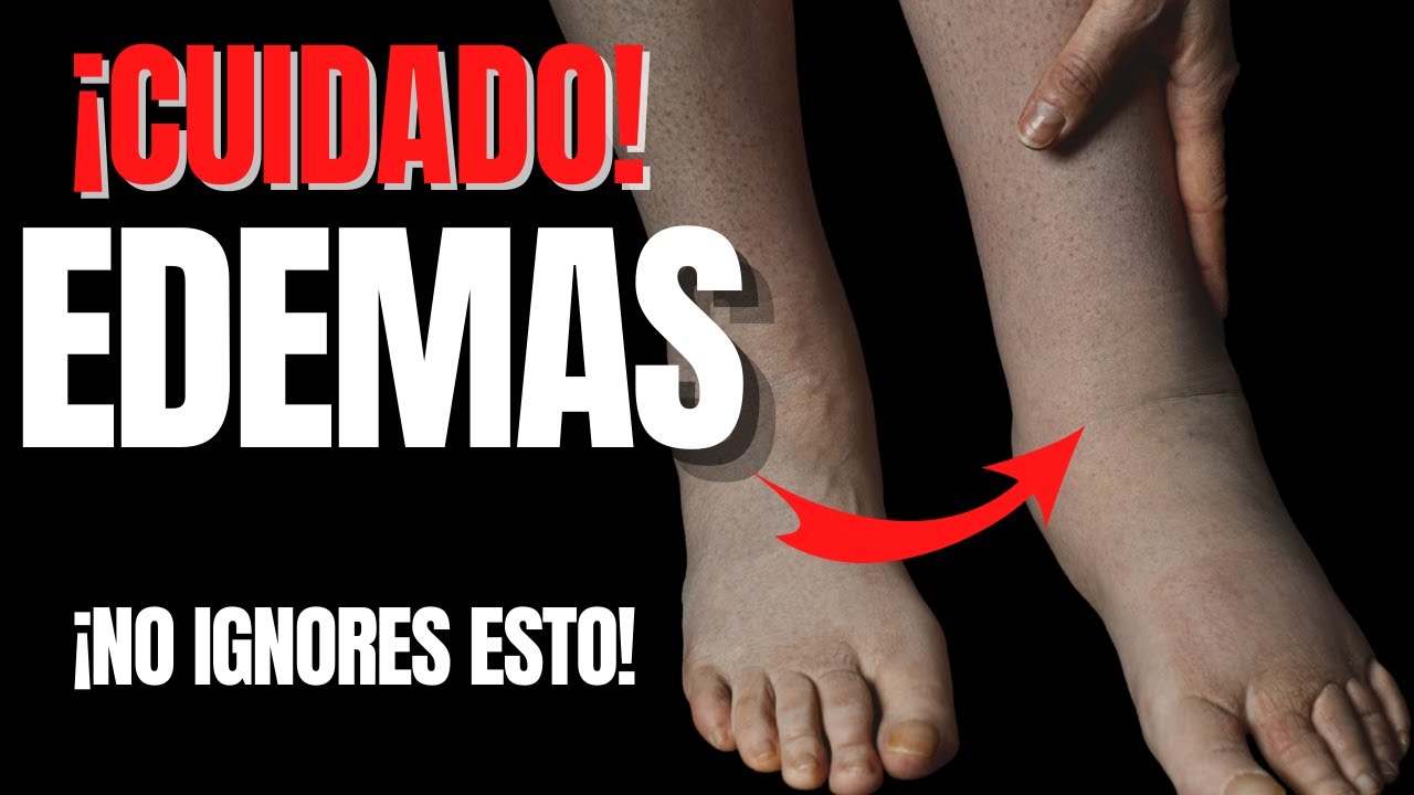 🔴¡ATENCIÓN! LO QUE NO TE CUENTAN SOBRE LOS EDEMAS🦵 - THE CAUSES OF ...