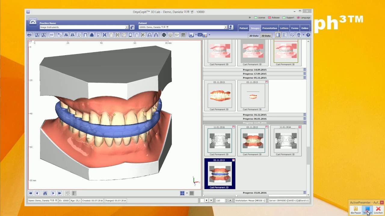 OnyxCeph³™ Module Waefer Creation 3D - YouTube