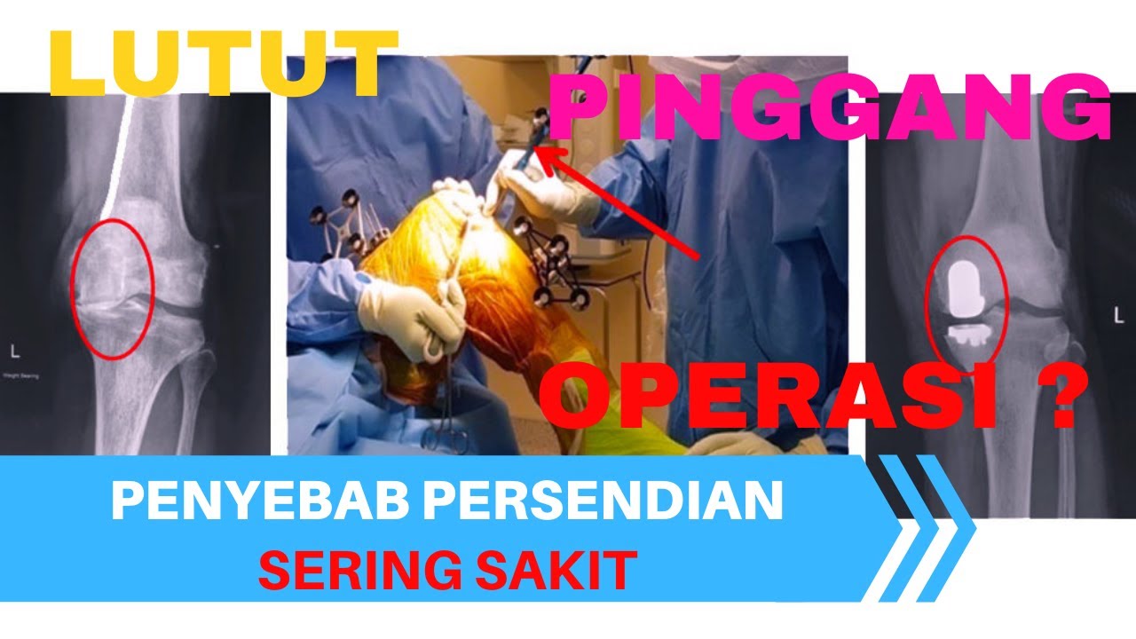 Persendian LUTUT, PINGGUL Sering Sakit (Osteoarthritis) Bisa Memicu ...