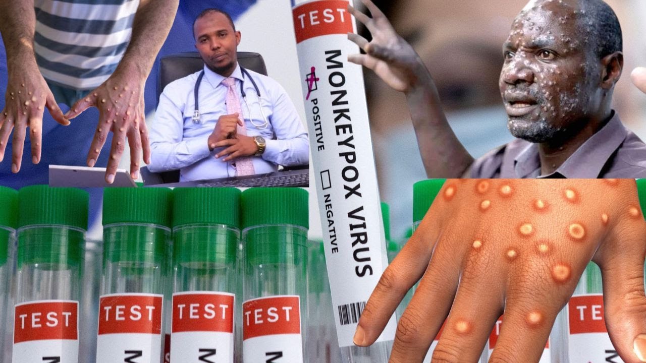 DEG DEG Xannuunka Halista ah ee Monkeypox oo KENYA Laga Helay Dr ...