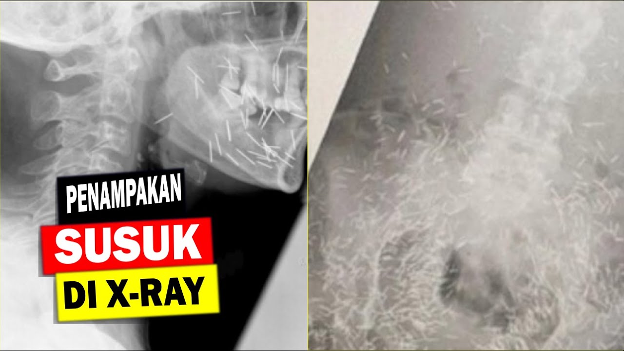 Viral Potret X-ray Pasien Diduga Pasang Susuk, Begini Faktanya - YouTube