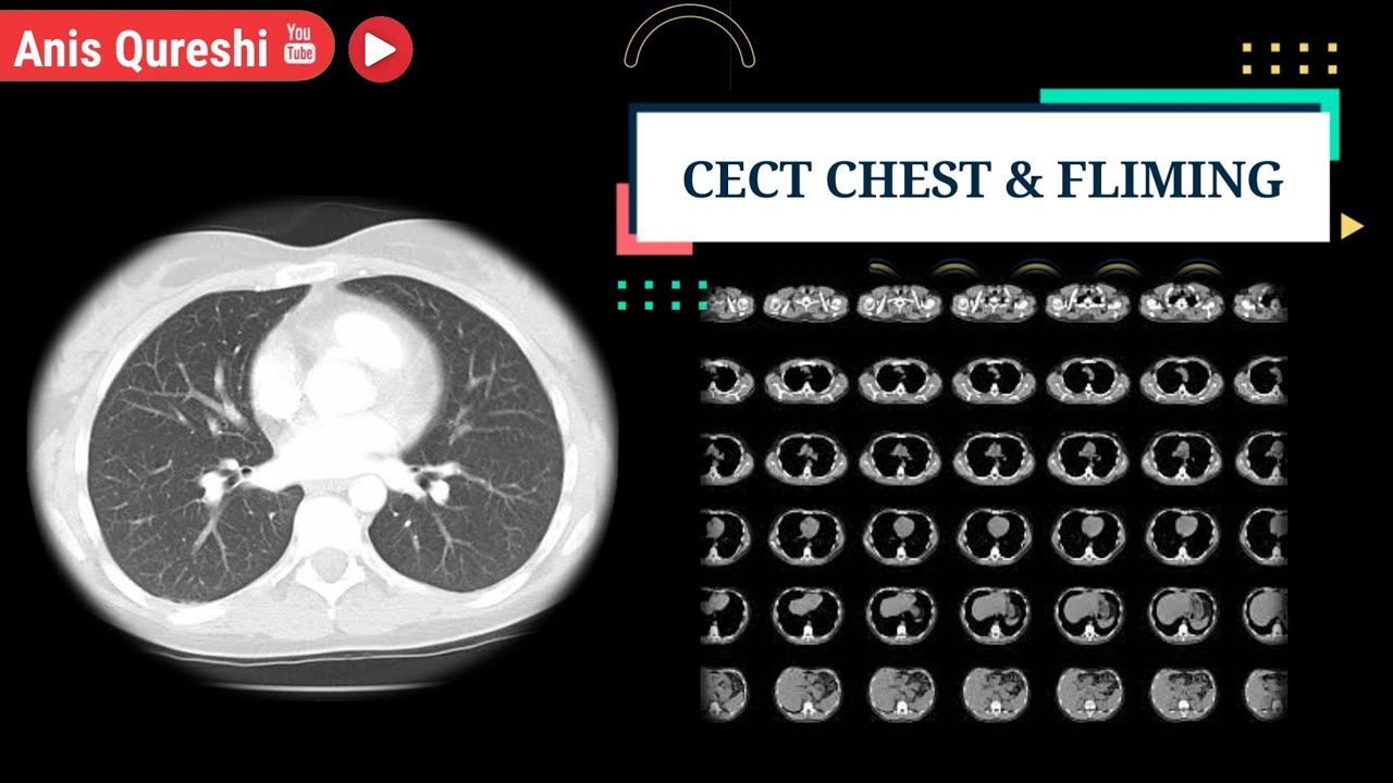 Cect Chest with Fliming | By Anis Qureshi - YouTube