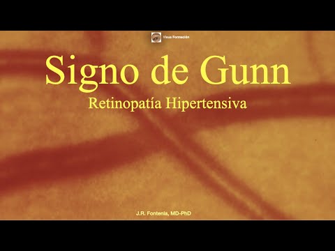 Signo de Gunn. Signo de Bonnet. Hipertensión Arterial. - YouTube