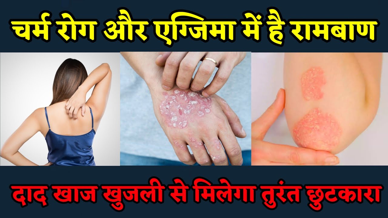 चर्म रोग और एग्जिमा में रामबाण \\ दाद खाज खुजली तो एक ही बार में खत्म ...