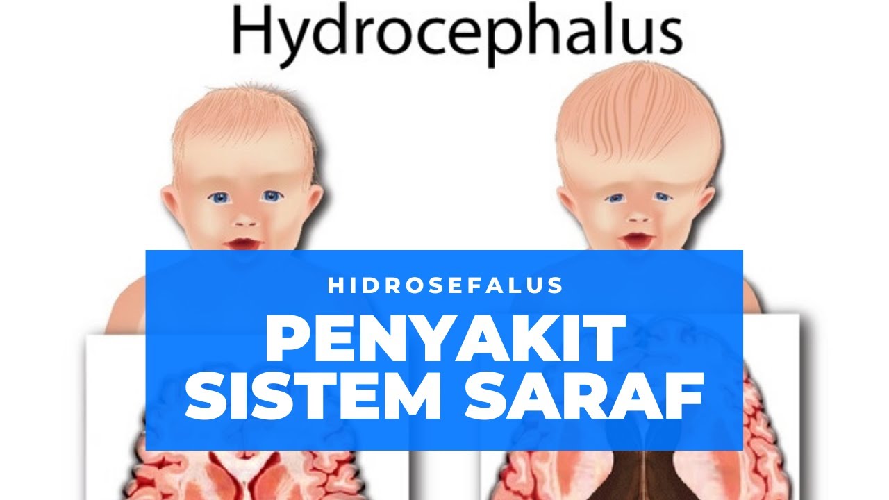 Penyakit Hidrosefalus - YouTube