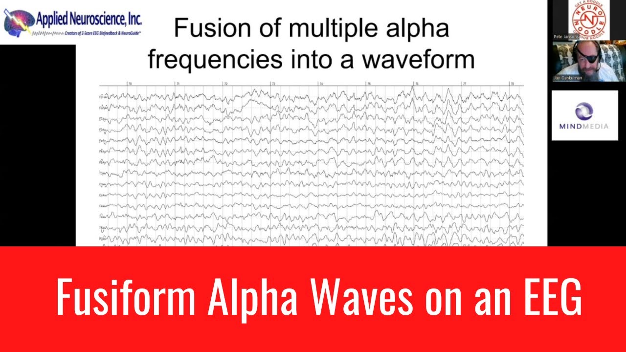 Fusiform EEG Alpha Waves - YouTube