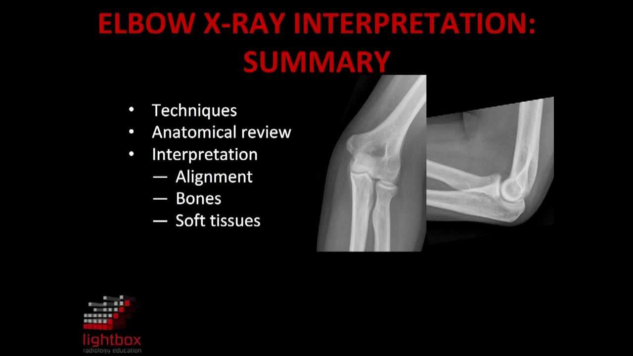 Elbow X-ray Interpretation - YouTube
