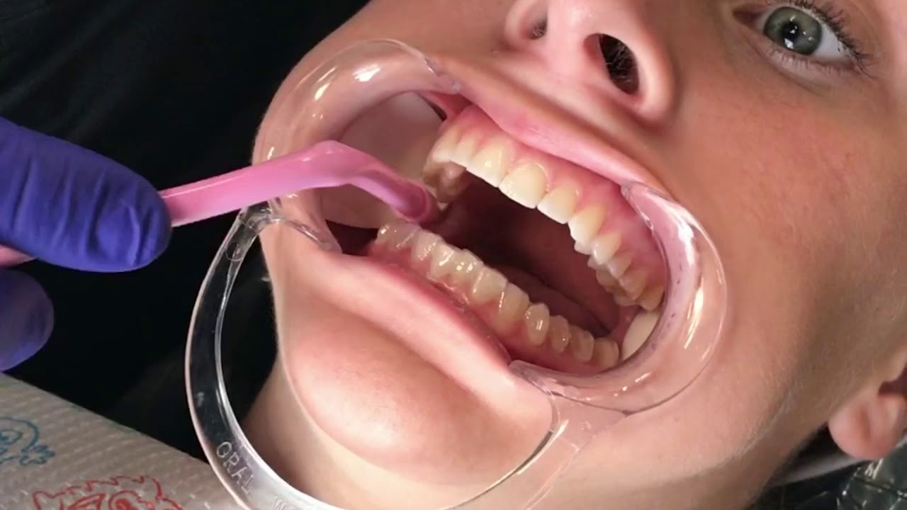 Bonding Invisalign Attachments - YouTube