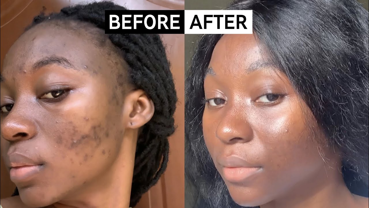 No more HYPERPIGMENTATION with skin boosters | decrease dark circles ...