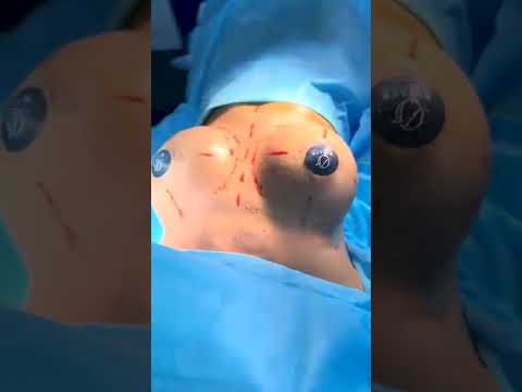 Красивая грудь — пластическое преображение #shorts