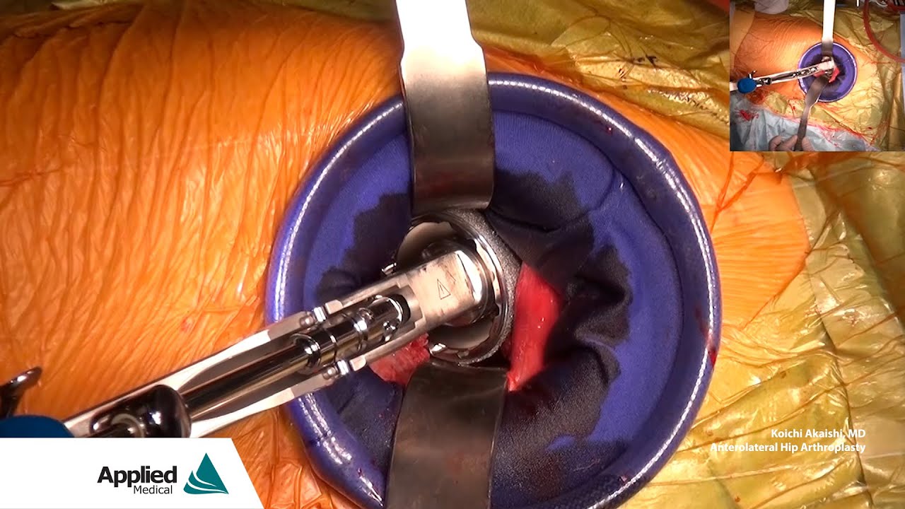 Anterolateral Hip Arthroplasty | Featuring the Alexis Orthopaedic ...