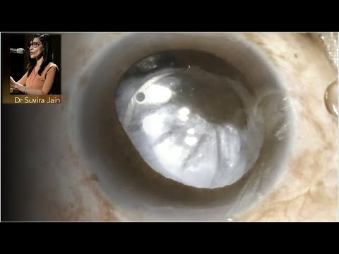 Surgical Management of residual Cortex after Cataract Surgery - YouTube