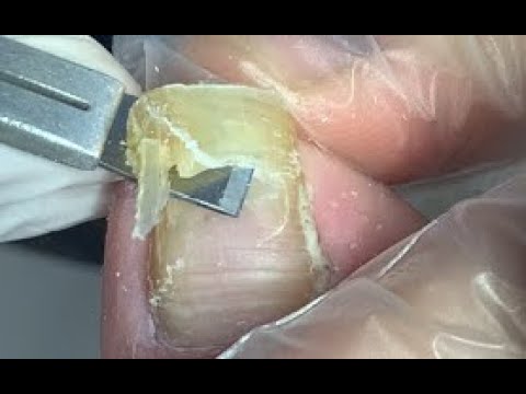 Super long nail cutting - YouTube