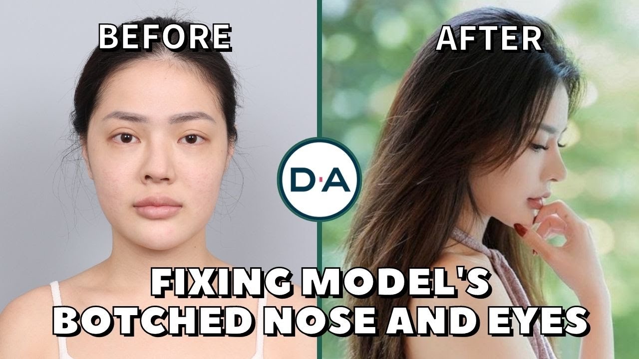 [Plastic Surgery Korea] Fixing Model's Botched Nose & Eyes/Revision ...