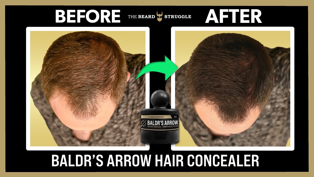 Cover up Bald Patches, Bald Spots & Grey Hair with The Beard Struggle ...