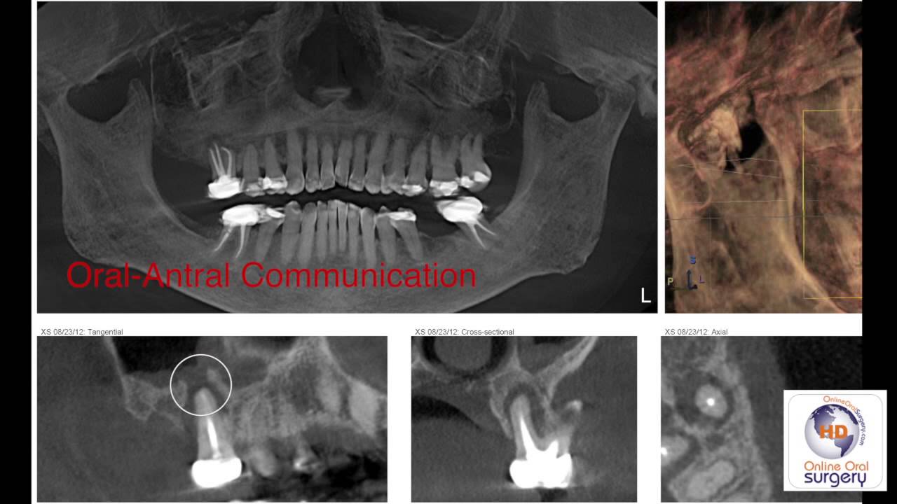 Extraction of Tooth #3, Closure of Oral-Antral Fistula - YouTube