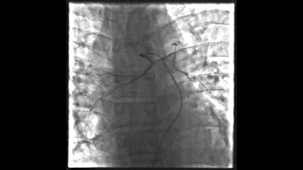 Embolisasi arteri bronkial - YouTube